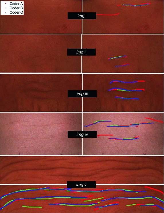 Automatic Wrinkle Detection Using Hybrid Hessian Filter | SpringerLink