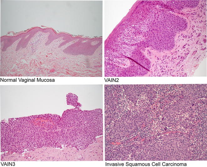 Diagnosis and Management of Vaginal Cancer | SpringerLink