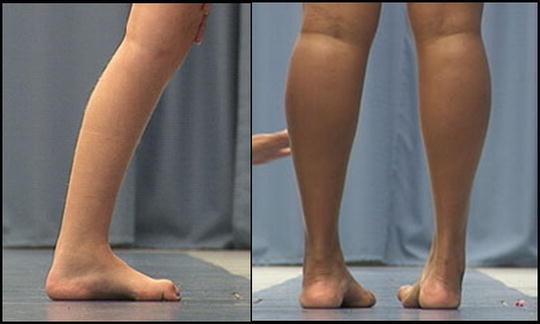 Lower Limb Deformity in Neuromuscular Disorders: Pathophysiology ...
