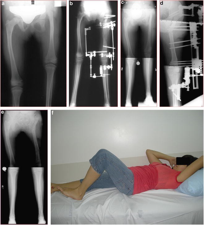 Congenital Femoral Deficiency Reconstruction and Lengthening Surgery ...