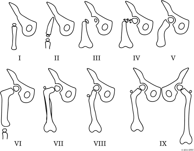 Congenital Femoral Deficiency Reconstruction and Lengthening Surgery ...