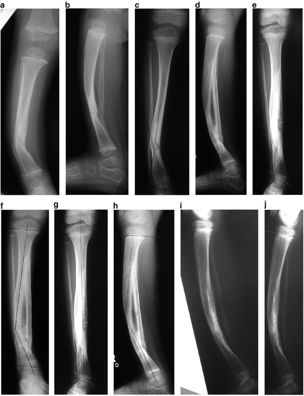 Congenital Pseudarthrosis of the Tibia | SpringerLink