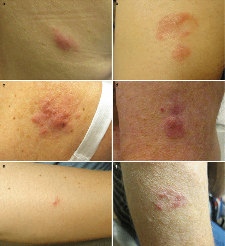 Primary Cutaneous Marginal Zone Lymphoma | SpringerLink