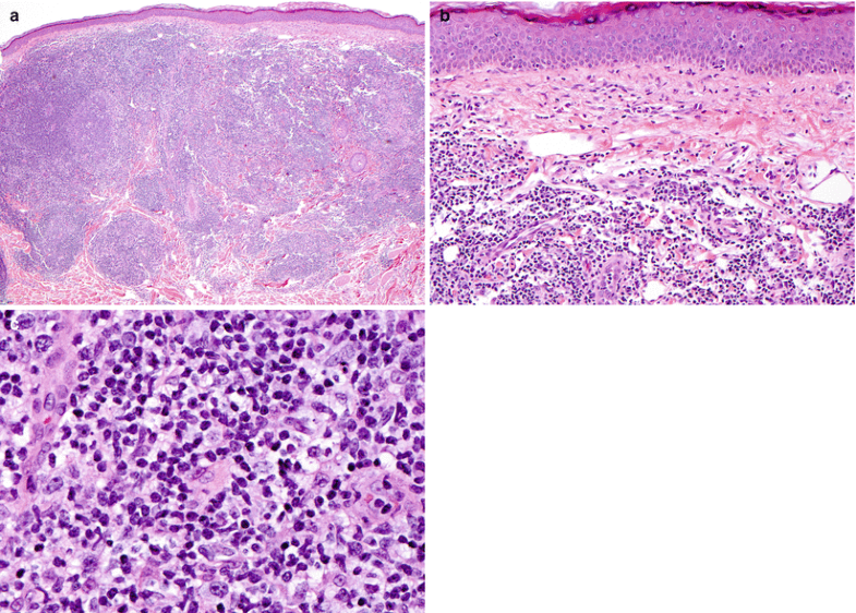 Primary Cutaneous Marginal Zone Lymphoma | SpringerLink