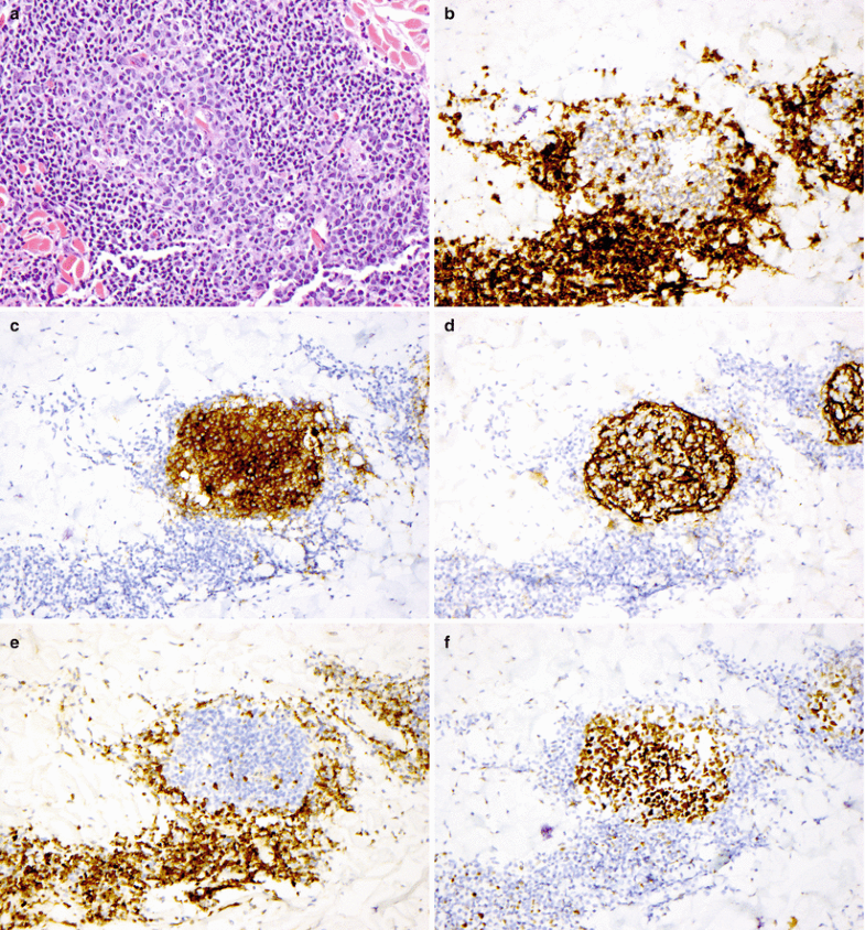 Primary Cutaneous Marginal Zone Lymphoma | SpringerLink