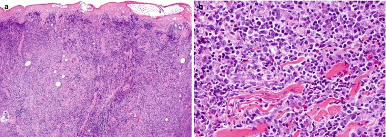 Primary Cutaneous Diffuse Large B-Cell Lymphoma, Leg Type | SpringerLink