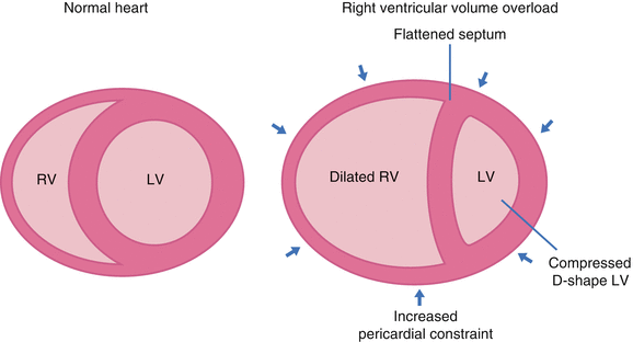 The Failing Right Ventricle in Adult Congenital Heart Disease ...