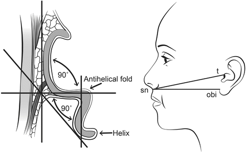 Otoplasty | SpringerLink