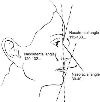Genioplasty | SpringerLink