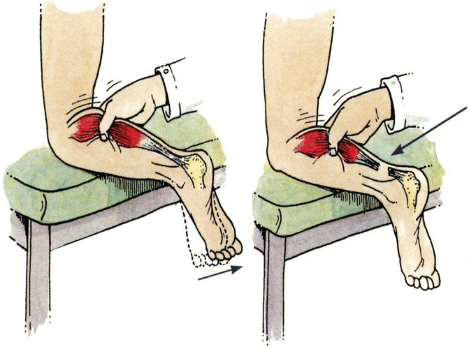 Achilles Tendon Lesions in Soccer Players | SpringerLink