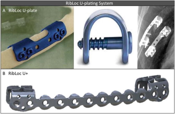 Biomechanics of Rib Fracture Fixation | SpringerLink