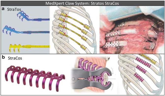 Biomechanics of Rib Fracture Fixation | SpringerLink