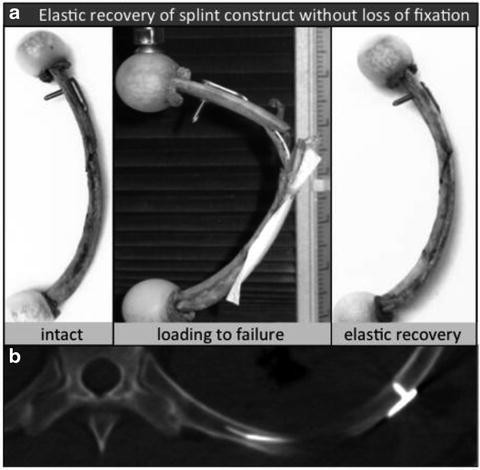 Biomechanics of Rib Fracture Fixation | SpringerLink