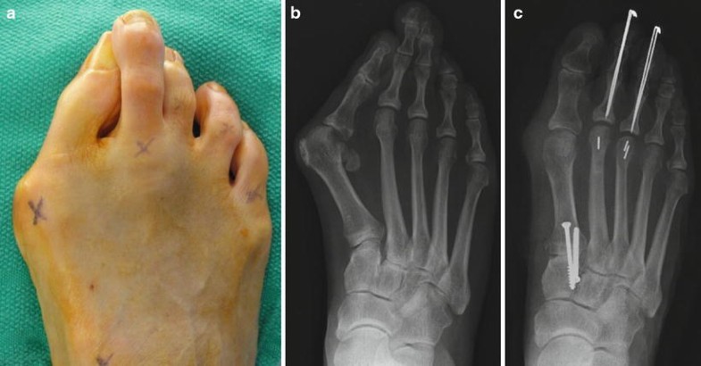 Osteomyelitis of the Central Toes | SpringerLink