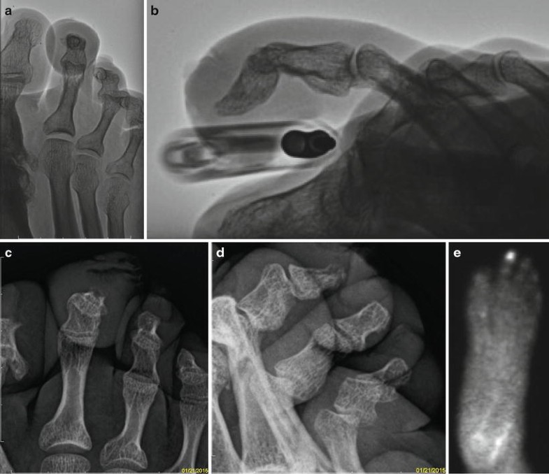 Osteomyelitis of the Central Toes | SpringerLink