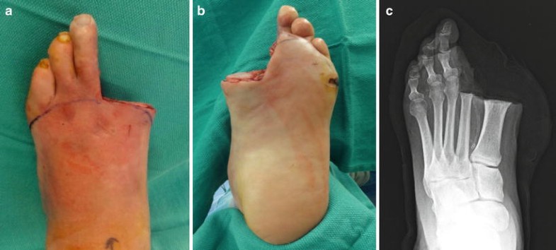 Transmetatarsal and Lisfranc Amputation | SpringerLink