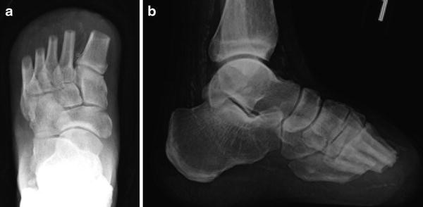 Transmetatarsal and Lisfranc Amputation | SpringerLink