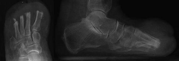 Transmetatarsal and Lisfranc Amputation | SpringerLink