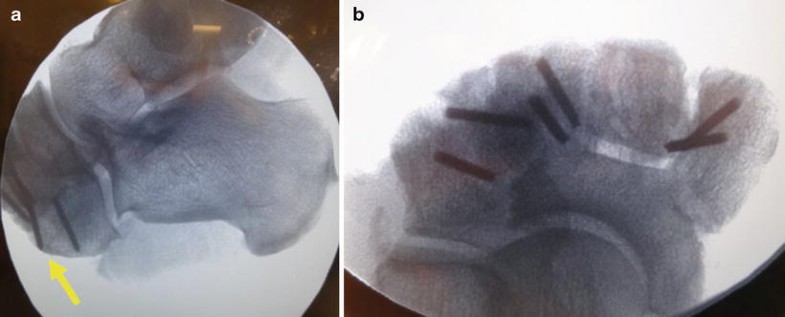 Transmetatarsal and Lisfranc Amputation | SpringerLink