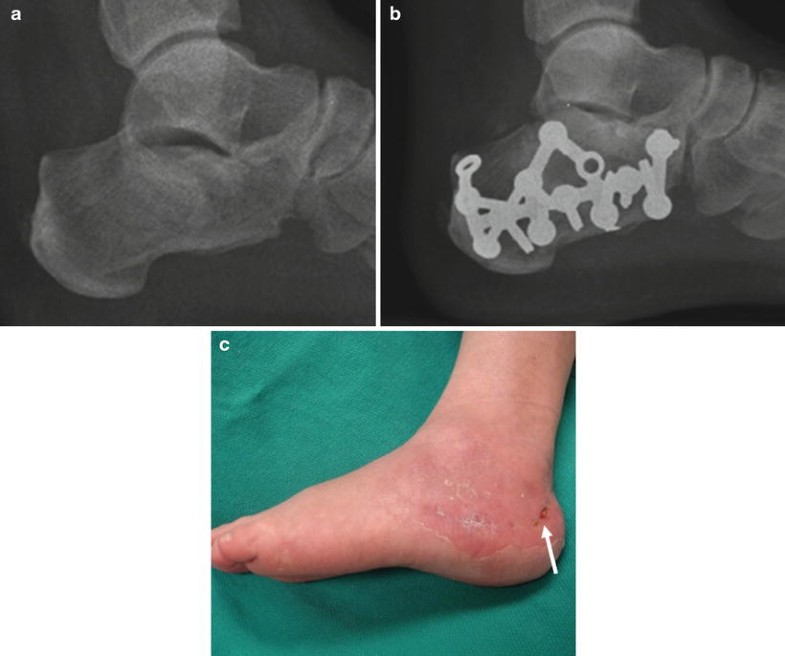 Osteomyelitis of the Calcaneus | SpringerLink