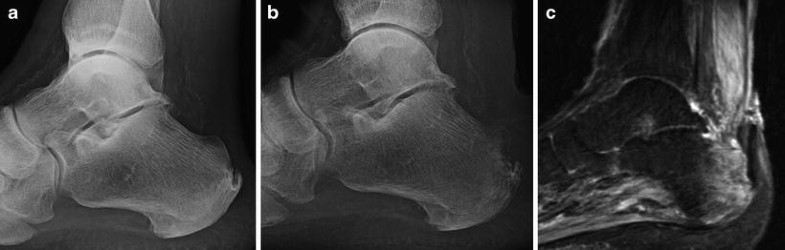 Osteomyelitis of the Calcaneus | SpringerLink