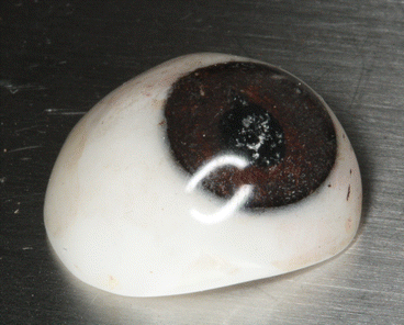 Mucoid Discharge Associated with Prosthetic Eye Wear | SpringerLink