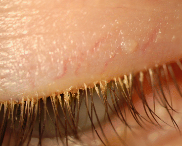 Mucoid Discharge Associated with Prosthetic Eye Wear | SpringerLink