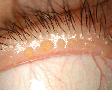 Mucoid Discharge Associated with Prosthetic Eye Wear | SpringerLink