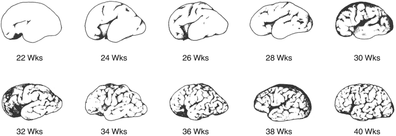 Macerated Stillbirth | SpringerLink