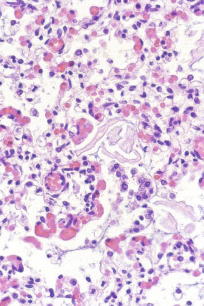 Macerated Stillbirth | SpringerLink