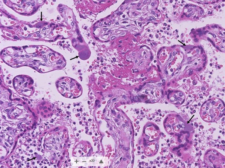 Macerated Stillbirth | SpringerLink