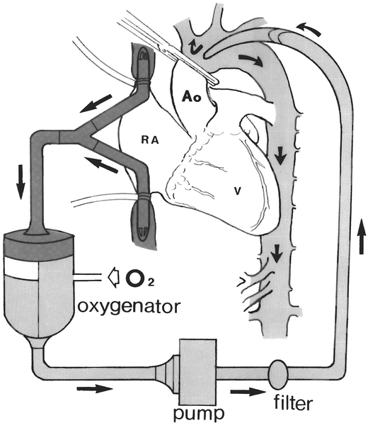 Cardiopulmonary Bypass and Cardioplegia | SpringerLink