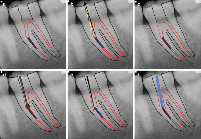 Separated Endodontic Instruments | SpringerLink