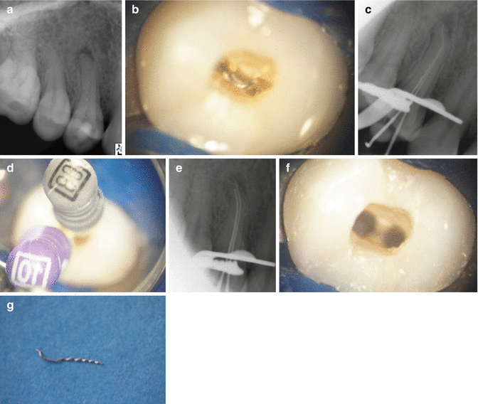Separated Endodontic Instruments | SpringerLink