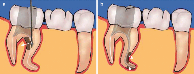 Iatrogenic Perforations | SpringerLink