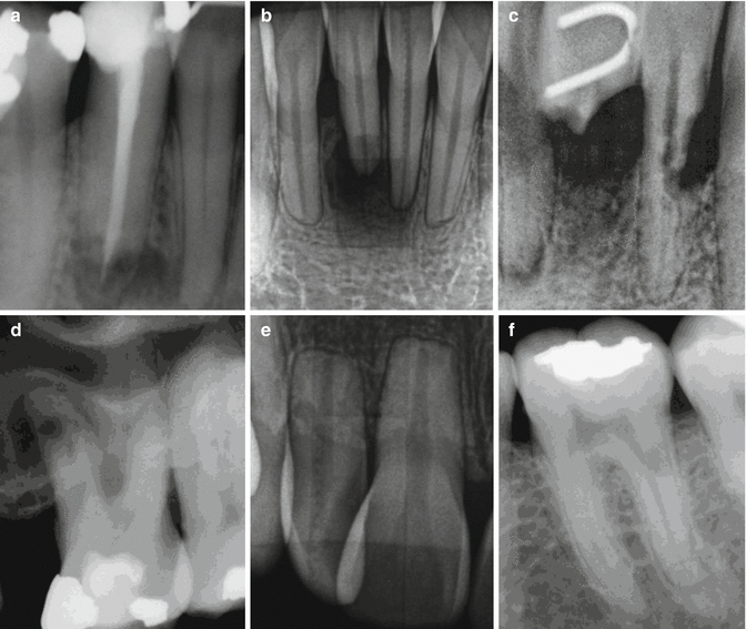 Root Resorption | SpringerLink