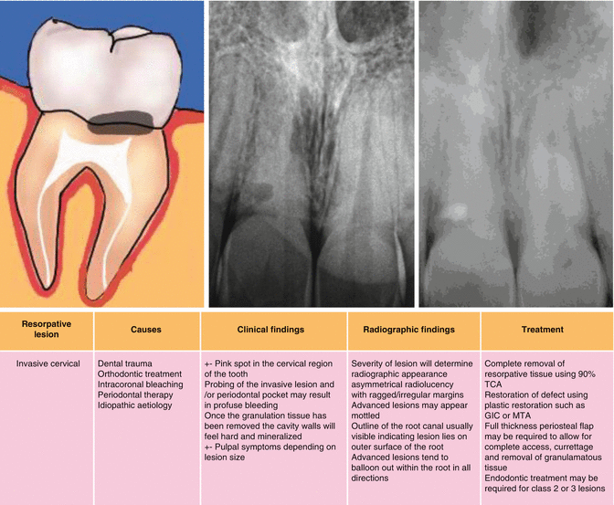 Root Resorption | SpringerLink