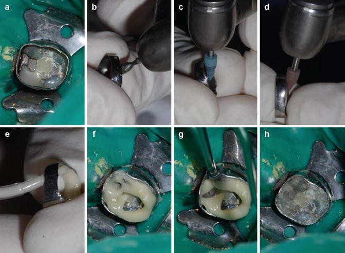 Temporary and Interim Restorations in Endodontics | SpringerLink