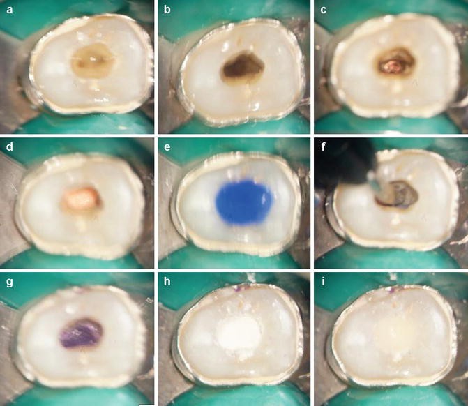 Temporary and Interim Restorations in Endodontics | SpringerLink