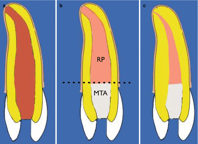 Apexogenesis, Apexification, Revascularization and Endodontic ...