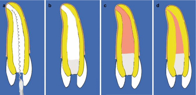 Apexogenesis, Apexification, Revascularization and Endodontic ...