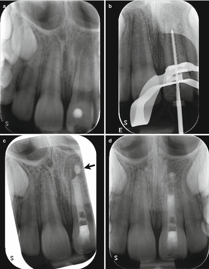 Apexogenesis, Apexification, Revascularization and Endodontic ...