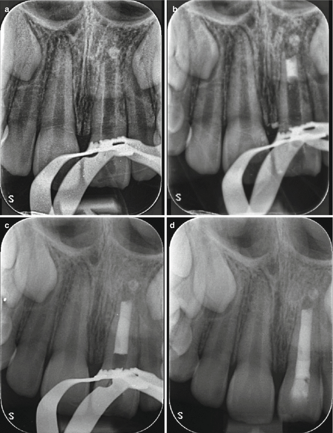Apexogenesis, Apexification, Revascularization and Endodontic ...