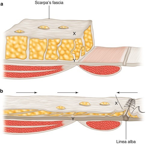 Medial Advancement of Infraumbilical Scarpa’s Fascia Improves Waistline ...