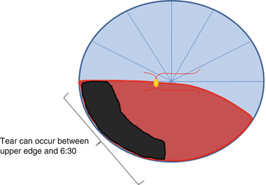 Retinal Detachment | SpringerLink