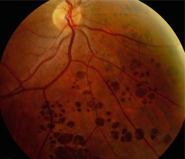 Congenital Hypertrophy of the Retinal Pigment Epithelium | SpringerLink