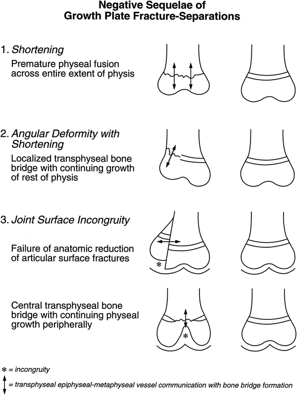 Epiphyseal Growth Plate Fracture-Separations | SpringerLink