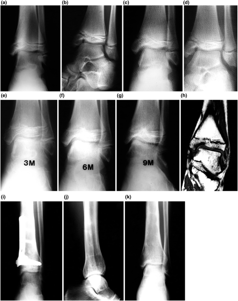 Epiphyseal Growth Plate Fracture-Separations | SpringerLink