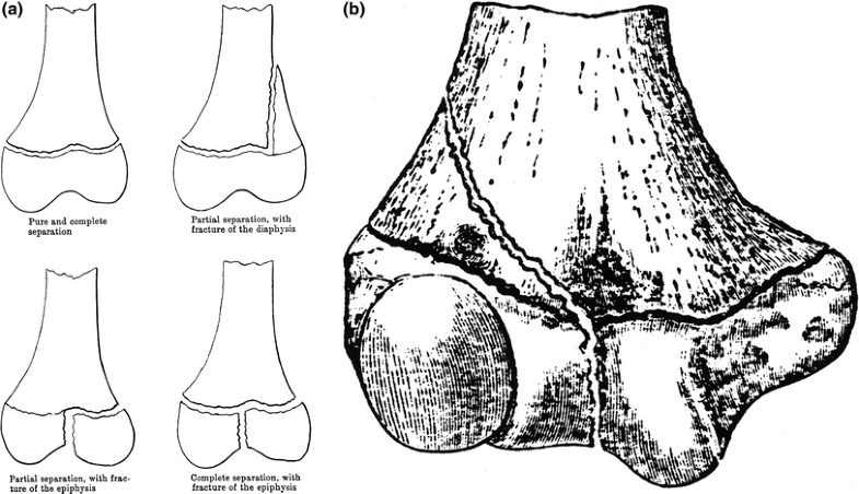 Epiphyseal Growth Plate Fracture-Separations | SpringerLink