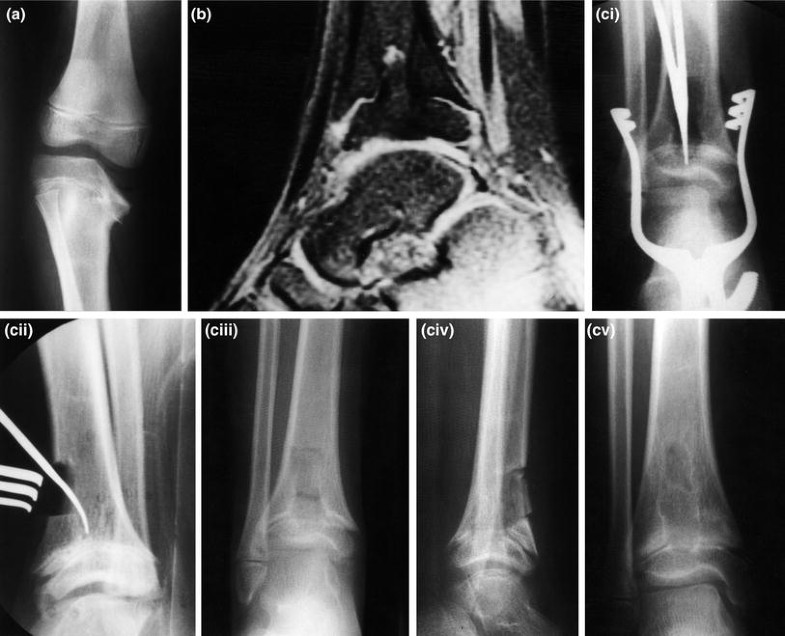 Lower Extremity Length Discrepancies | SpringerLink